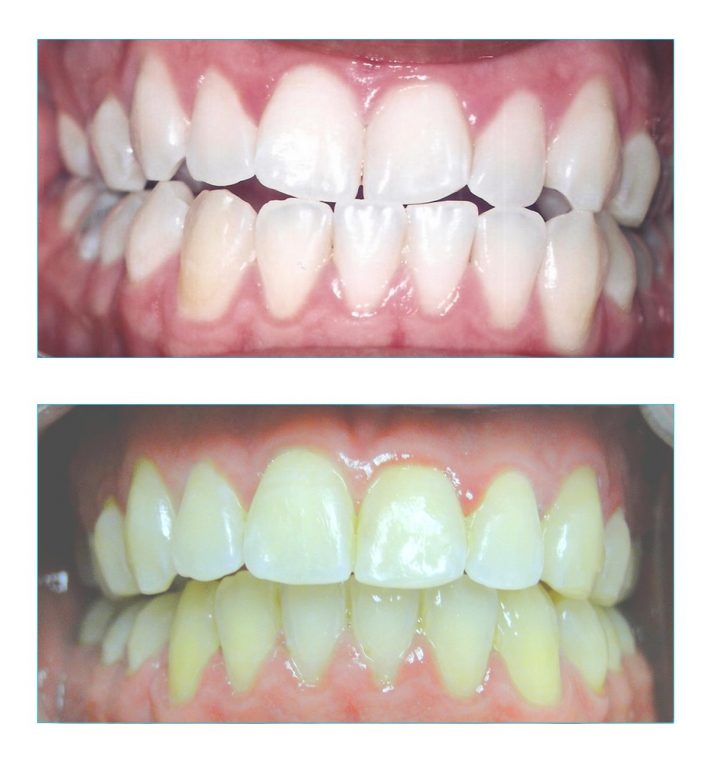 Tratamento compensatório de prognatismo mandibular | Dr. André Moreira