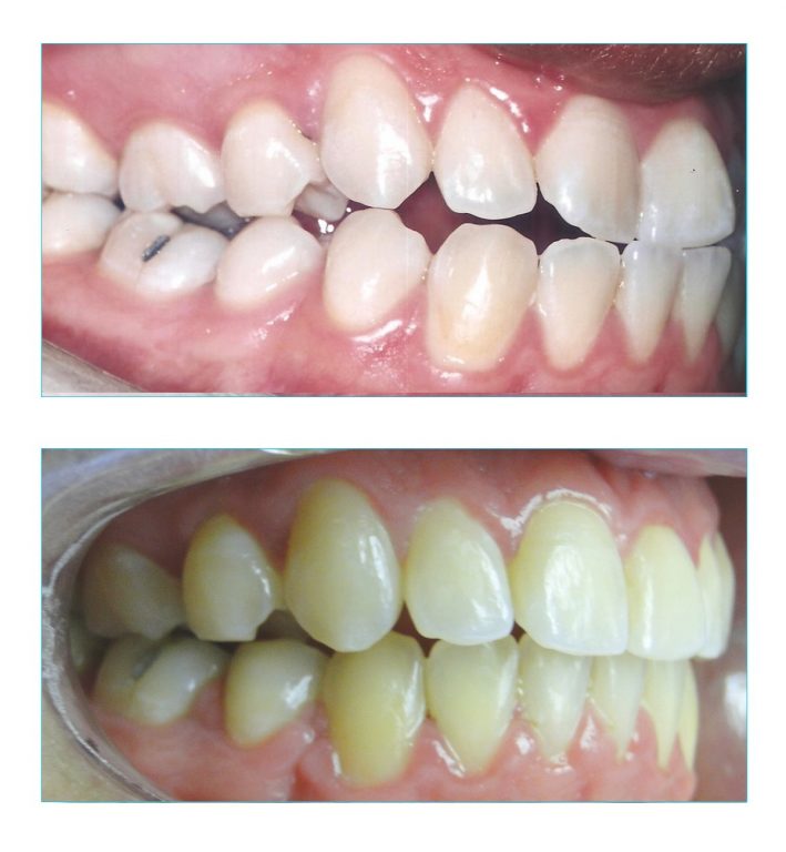 Tratamento compensatório de prognatismo mandibular | Dr. André Moreira