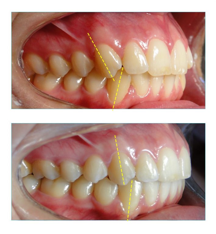 Expansão das arcadas, desinclinação e alinhamento | Dr. André Moreira